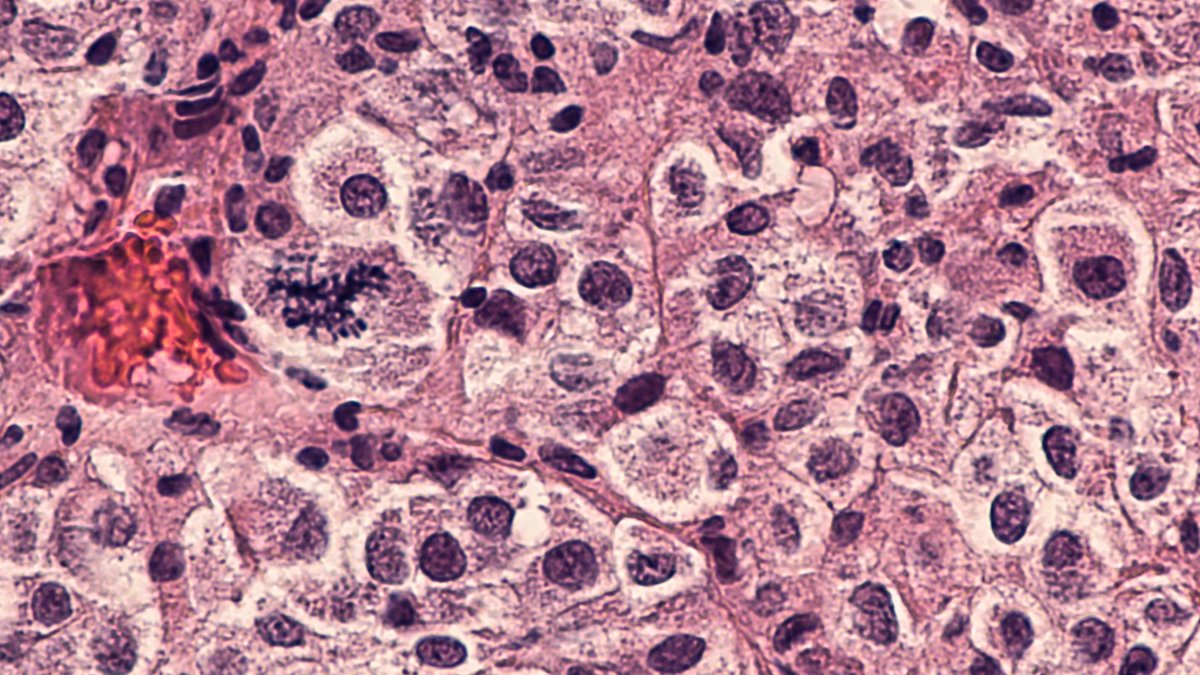 La terapia TIL ofrece esperanza a pacientes con melanoma metastásico ...